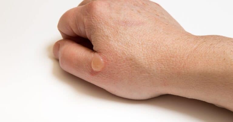 10 Acute Bacterial Skin Infections You Should Never Take It Easy ...